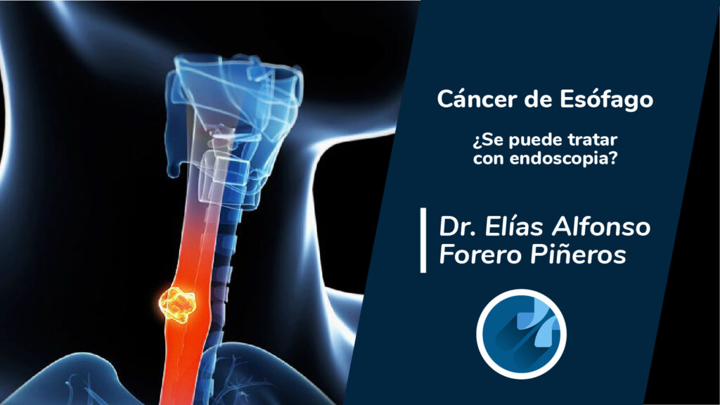 Cáncer de esófago: ¿Se puede tratar con Endoscopia? – Dr. Elías Forero.